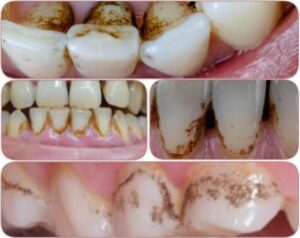 How to Remove Black Stains from Teeth? - KeepTeethStrong