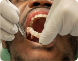 How to Clean Dentures Stains?