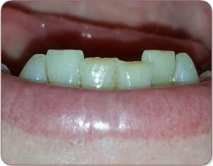 How to Fix Overcrowding Teeth?