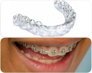 My Retainer Hurts my Gums, what to Do?