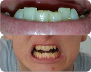 How to Fix Crooked Teeth Without Braces (Metal Aligners)?