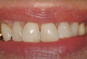 Hairline Tooth Fractures: A Comprehensive Guide