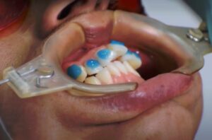 Teeth with Long Roots: All You Need to Know