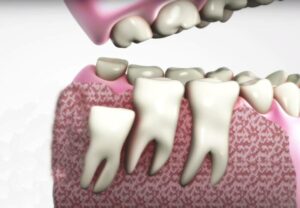 Is It Bad if Your Wisdom Teeth Grow Crooked? What Causes Them?