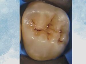 Deep Grooves in Teeth: What to Do?
